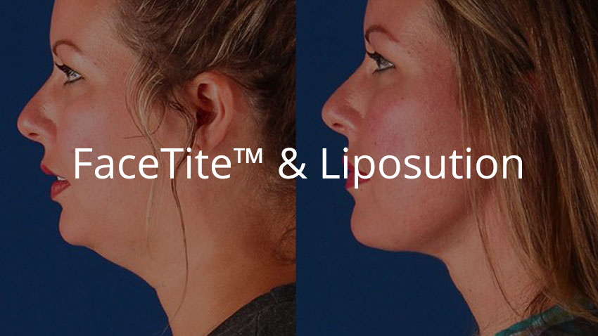 FaceTite™ and Liposuction: a 1-2 Punch for Treatment of the Neck ...