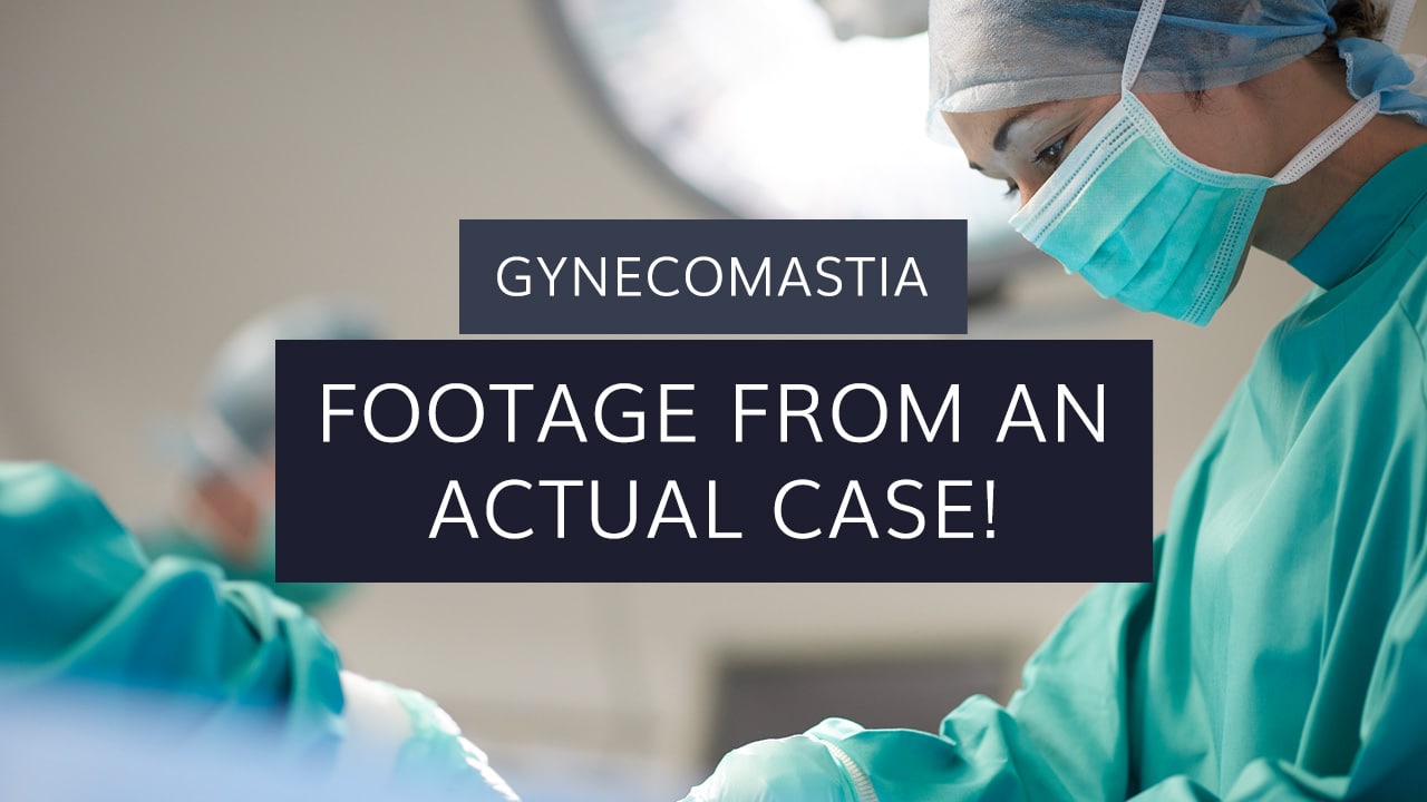 Gynecomastia: Footage From An Actual Case! | Jason Martin M.D.